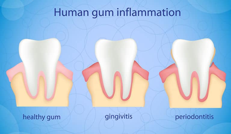Inflamed Gums FAQ | Fairbanks Dentist AK